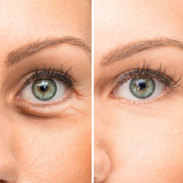 LUMIN-EYE, effectieve behandeling tegen wallen